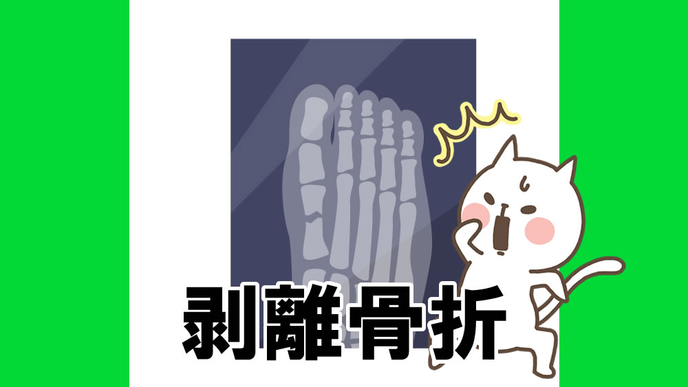 ジュニアユース 練習中「突き指」と思ったら「剥離骨折」だった話。よくそれで走ったなぁ・・・(^^;) | Ballond ( バロンド )